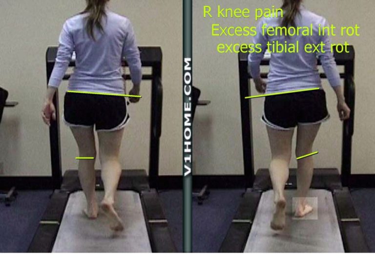 Knee Pain Wringing Out - Gait Deviation - Damien Howell PT