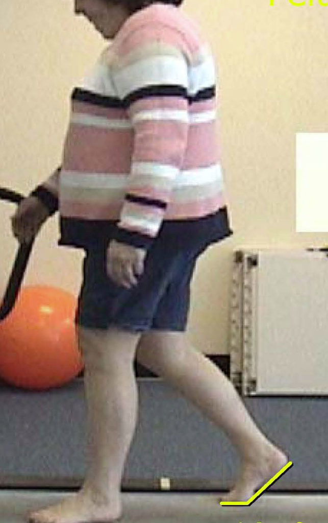 Gait deviations clustering gait deviations – injury – new data - Damien ...